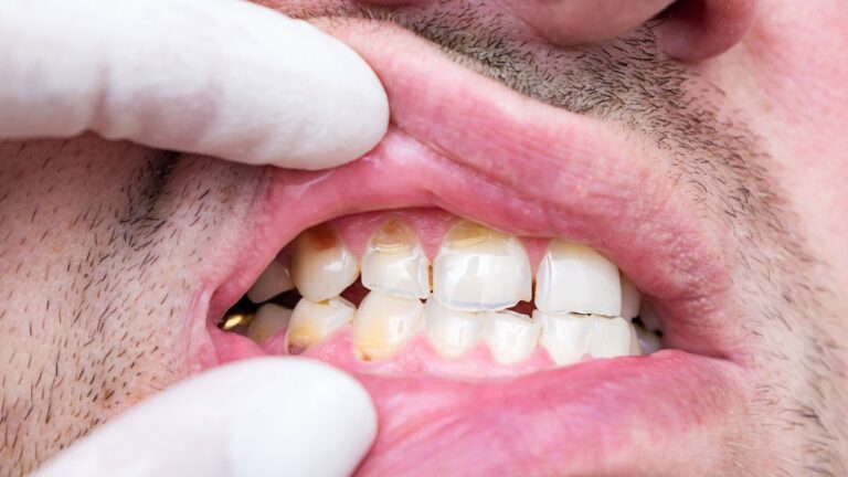 Why Teeth Turn Yellow With Age And How To Reverse it? Restore Your ...